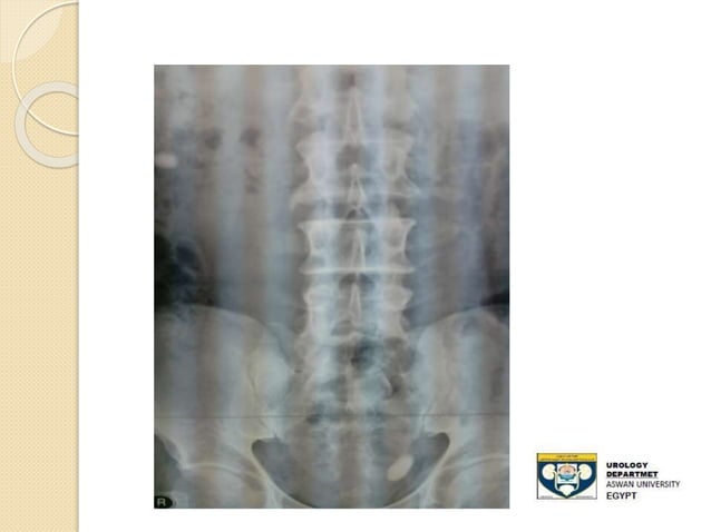 Evaluation and management of ureteric stones | PPTX | Digestive ...