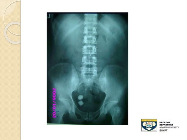 Evaluation and management of ureteric stones | PPTX | Digestive ...