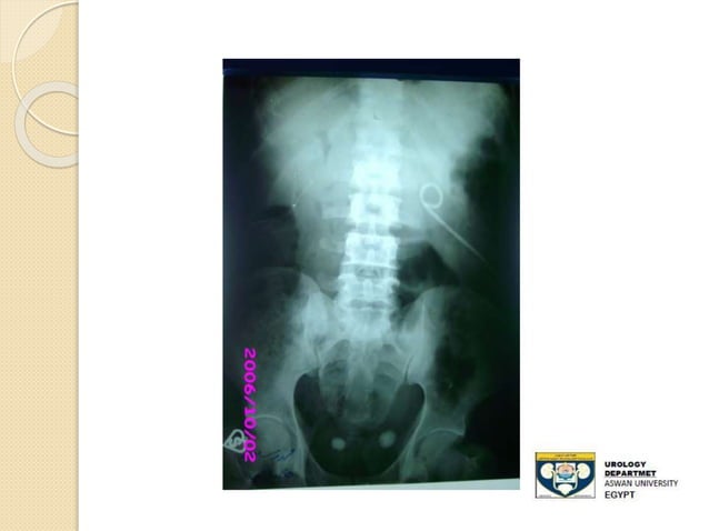 Evaluation and management of ureteric stones | PPTX | Digestive ...