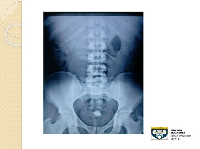 Evaluation and management of ureteric stones | PPTX | Digestive ...