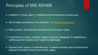 Evaluation & management of iridodialysis final 08.01.20