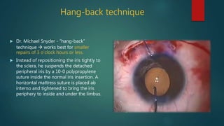 Evaluation & management of iridodialysis final 08.01.20