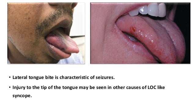 Evaluation of acute seizure in emergency