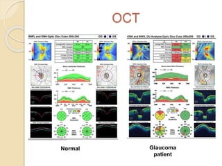 Evaluation of a glaucoma patient | PPTX