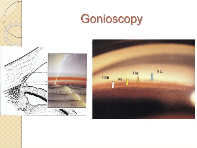 Evaluation of a glaucoma patient