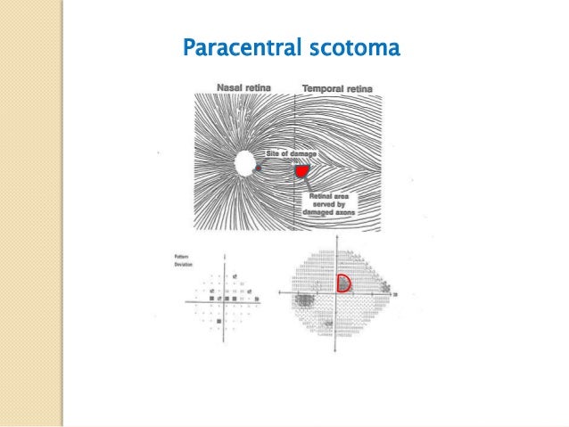 Evaluation of a glaucoma patient