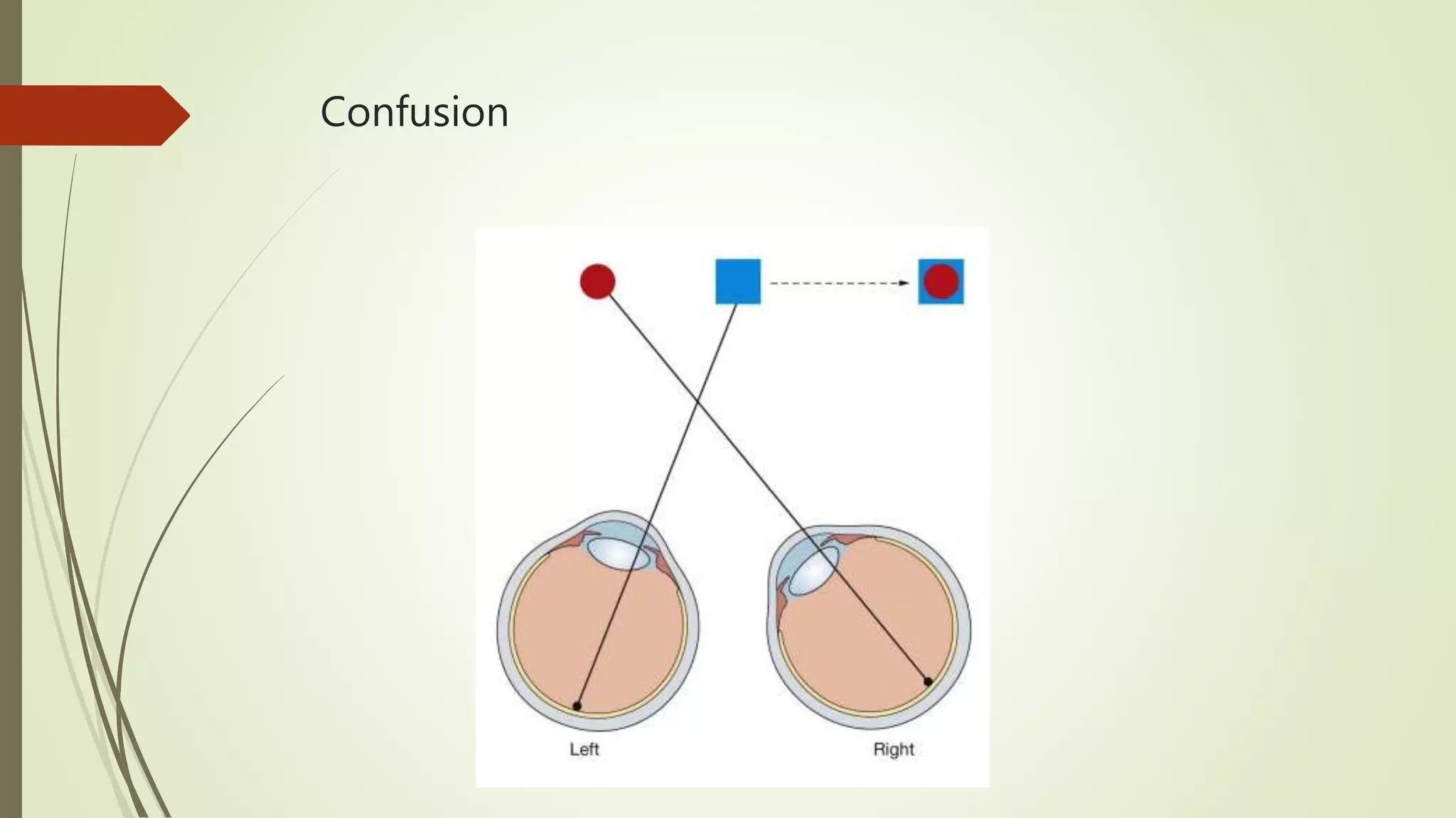 Evaluation of a patient with diplopia | PPTX