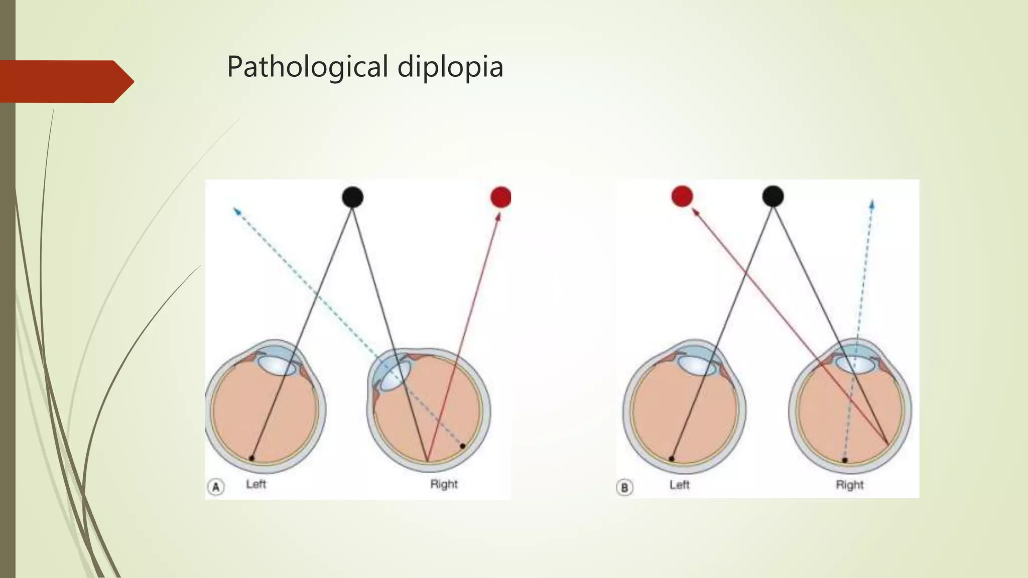 Evaluation of a patient with diplopia | PPTX