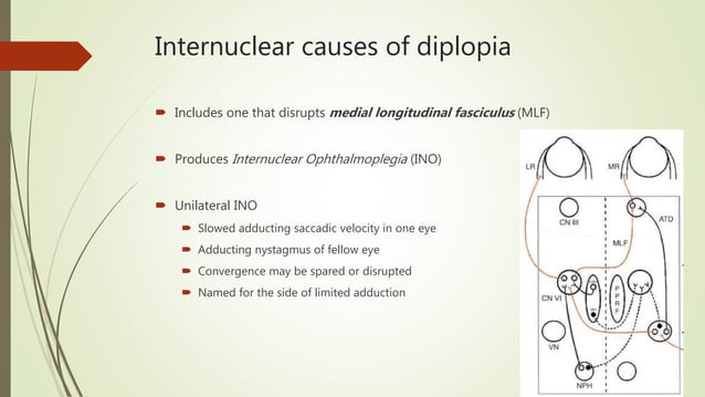 Evaluation of a patient with diplopia | PPTX | Eye and Vision Conditions | Diseases and Conditions
