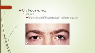 Evaluation of a patient with diplopia | PPTX