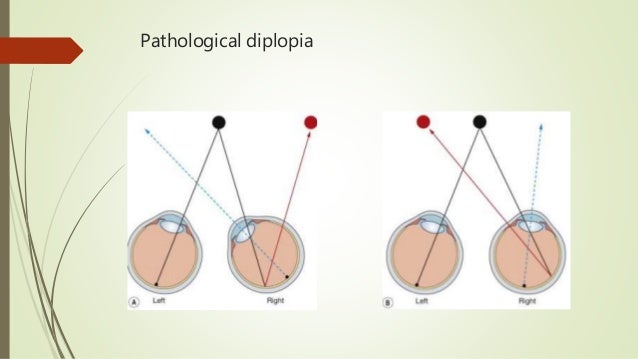 Evaluation of a patient with diplopia