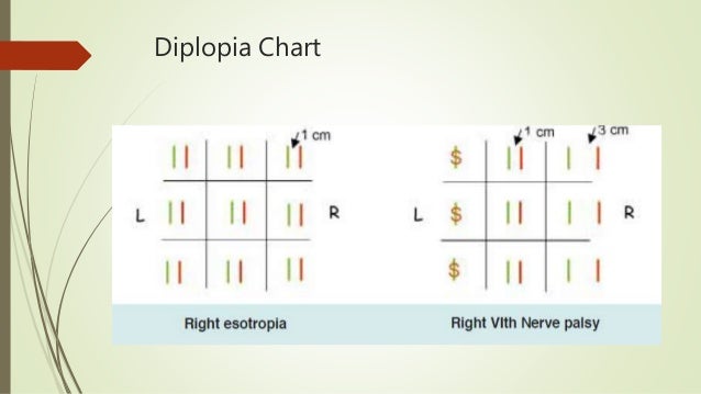 Evaluation of a patient with diplopia