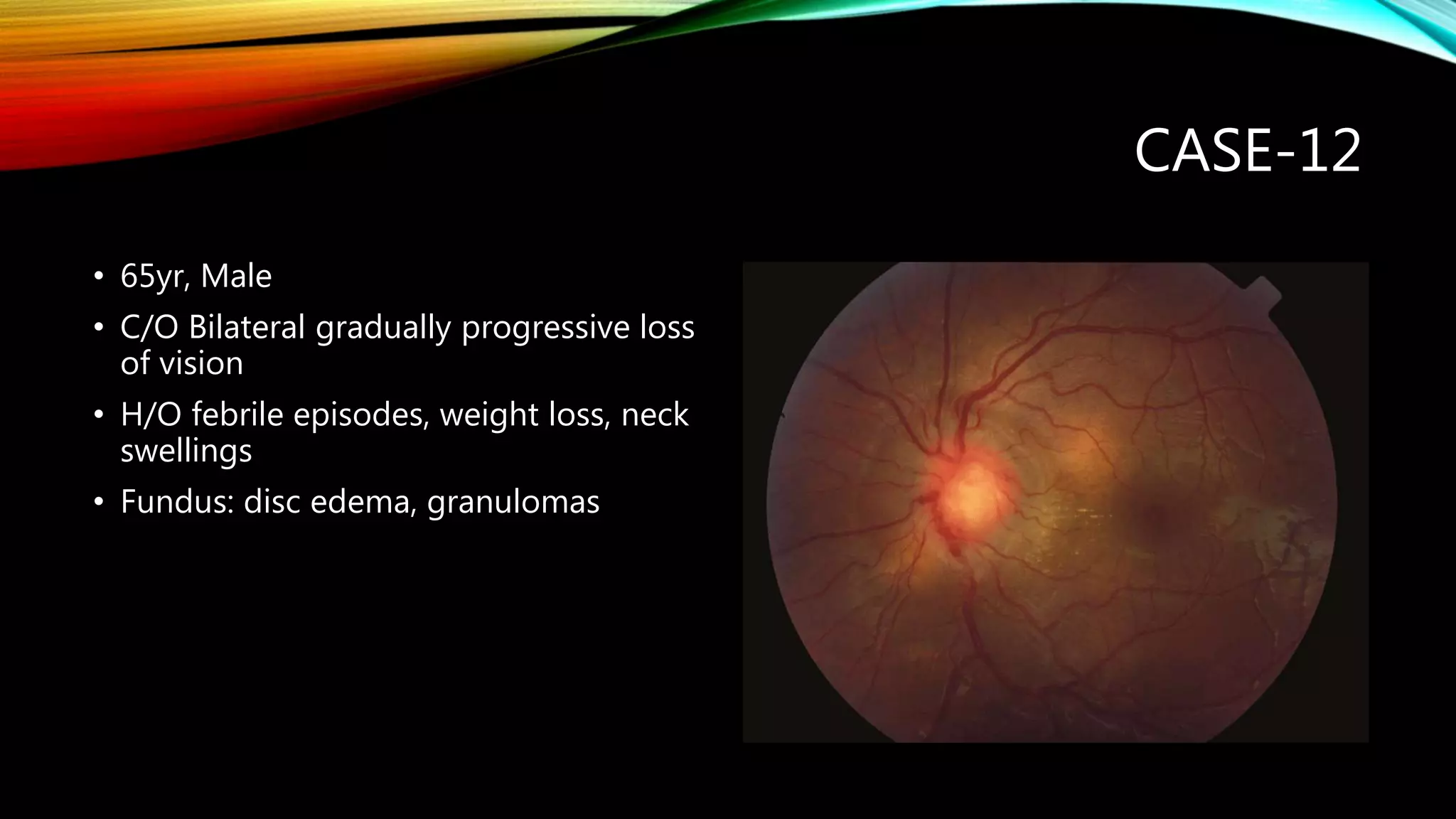 Evaluation of a patient with disc edema | PPTX