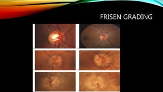 Evaluation of a patient with disc edema | PPTX