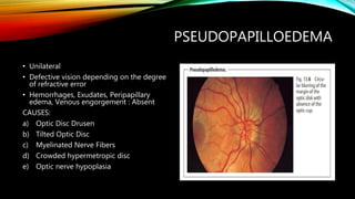 Evaluation of a patient with disc edema | PPTX
