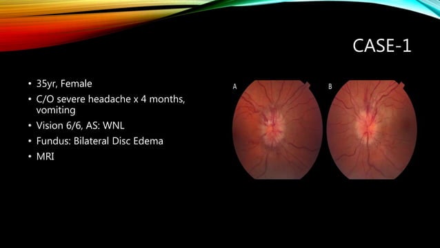 Evaluation of a patient with disc edema | PPTX