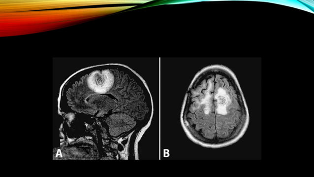 Evaluation of a patient with disc edema | PPTX