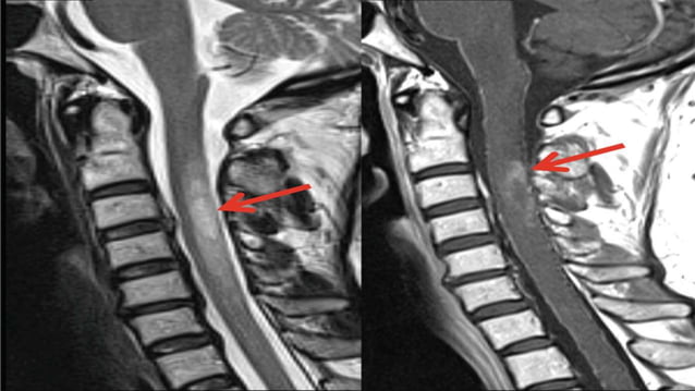 Evaluation of a patient with disc edema | PPTX
