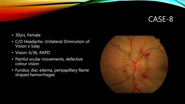 Evaluation of a patient with disc edema | PPTX