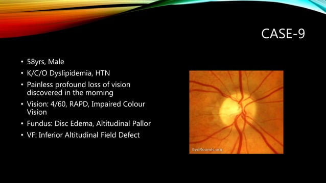Evaluation of a patient with disc edema | PPTX