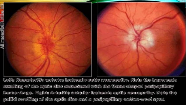 Evaluation of a patient with disc edema | PPTX