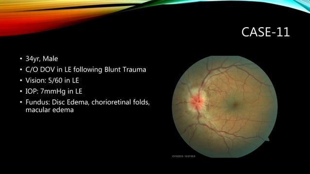 Evaluation of a patient with disc edema | PPTX