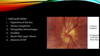 Evaluation of a patient with disc edema | PPTX