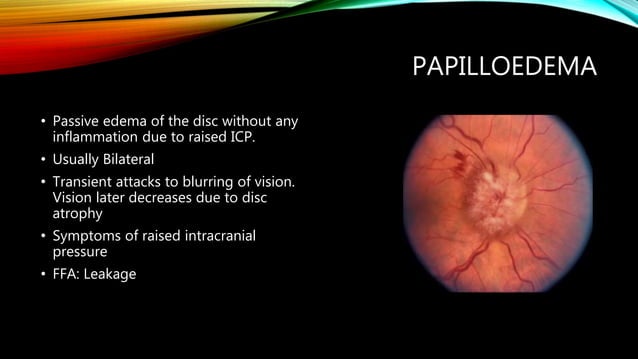 Evaluation of a patient with disc edema | PPTX