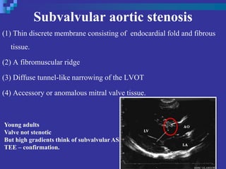 ECHOCARDIOGRAPHIC EVALUATION OF AORTIC STENOSIS | PPT