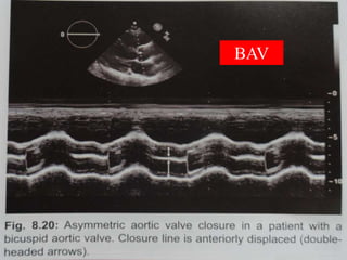 Bicuspid Aortic Valve M Mode