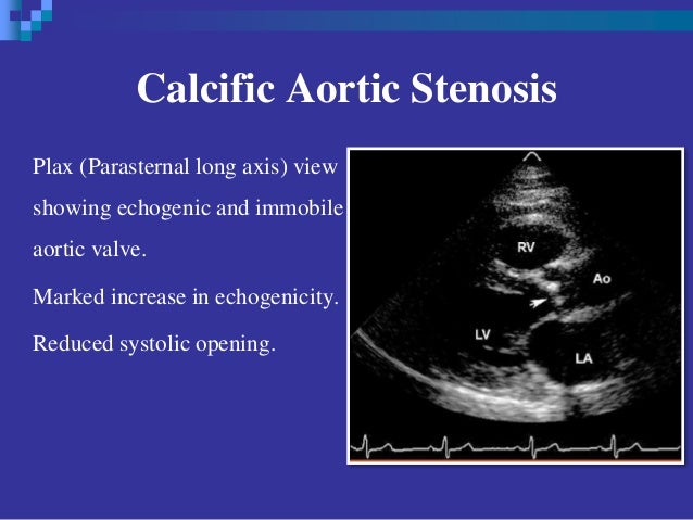 Pvc Echo Parasternal Long Axis View Aortic Stenosis Psax