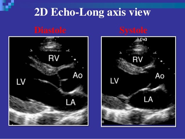 Echocardiographic Evaluation Of Aortic Stenosis