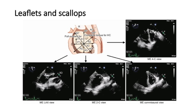 evaluation of mitral valve -TEE approach.pptx