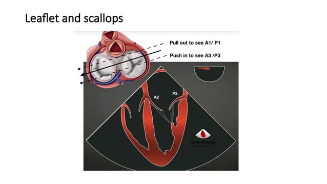 evaluation of mitral valve -TEE approach.pptx