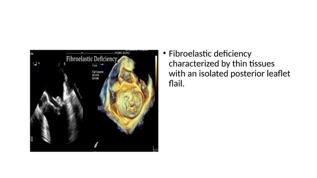 evaluation of mitral valve -TEE approach.pptx