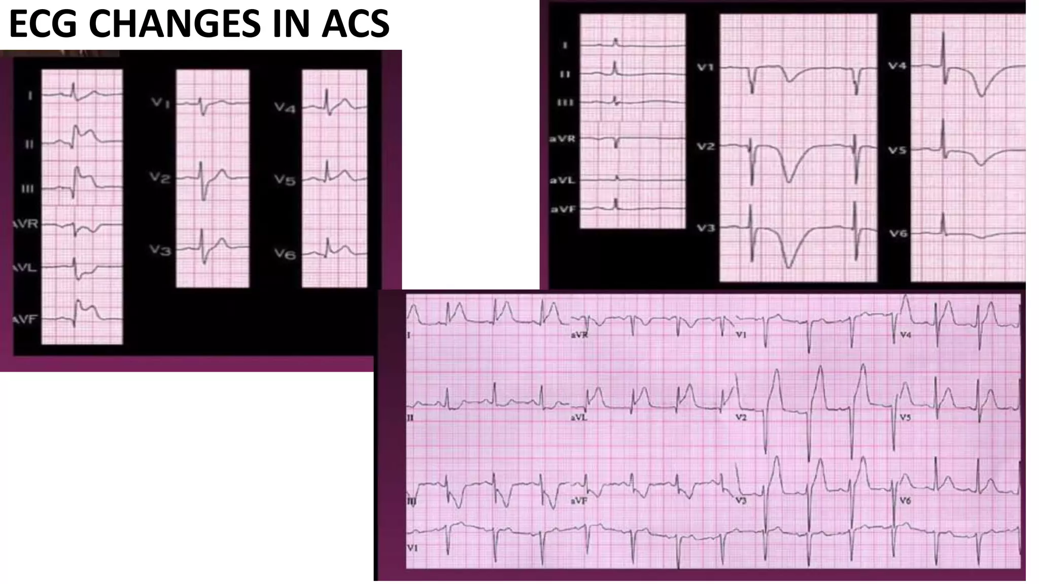 Evaluation of patient with chest pain in primary | PPTX