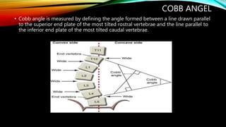 Evaluation of pediatric spinal deformities | PPT