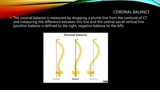 Evaluation of pediatric spinal deformities | PPT