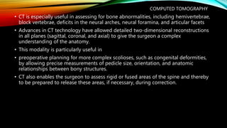 Evaluation of pediatric spinal deformities | PPT