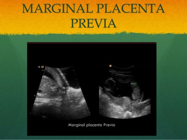 Radiological evaluation of the Placenta