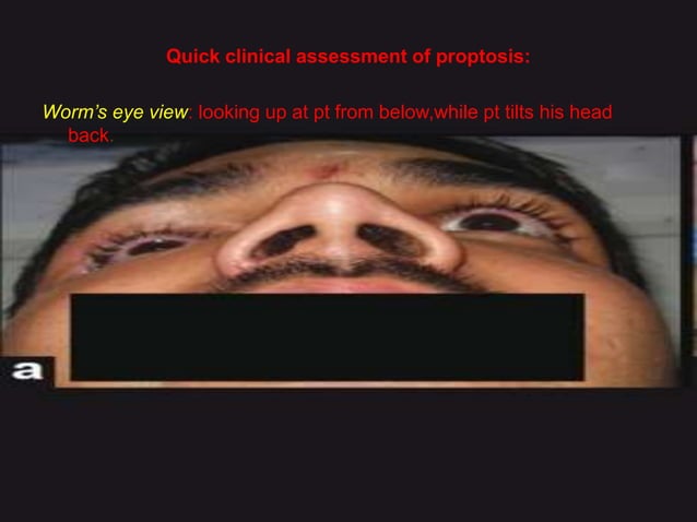 Evaluation of proptosis | PPTX | Eye and Vision Conditions | Diseases ...