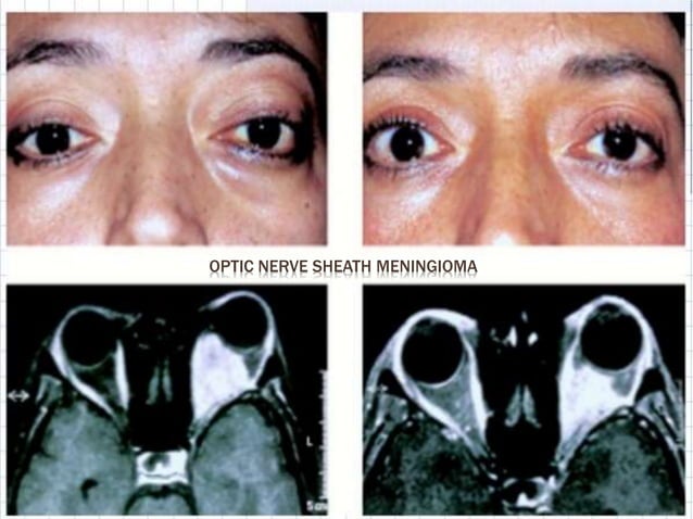 Evaluation of proptosis | PPTX | Eye and Vision Conditions | Diseases ...