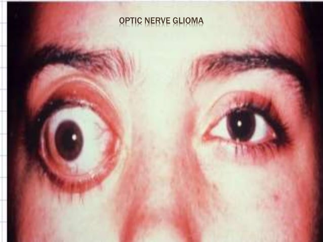 Evaluation of proptosis | PPTX | Eye and Vision Conditions | Diseases ...