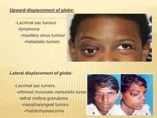 Exophthalmos Vs Proptosis