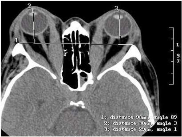 Evaluation of proptosis