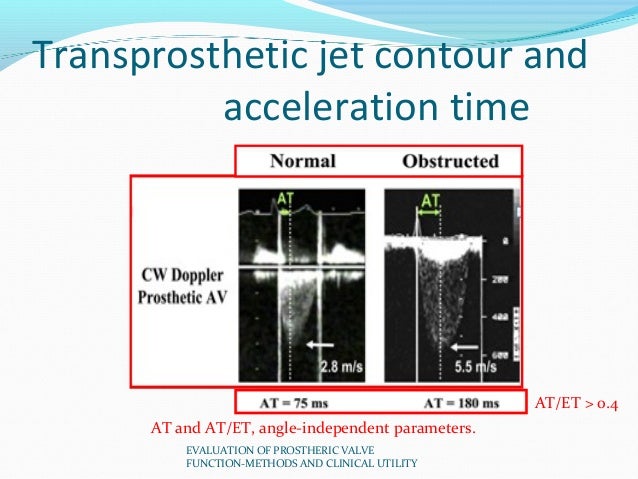 Evaluation of prosthetic valve function and clinical utility.