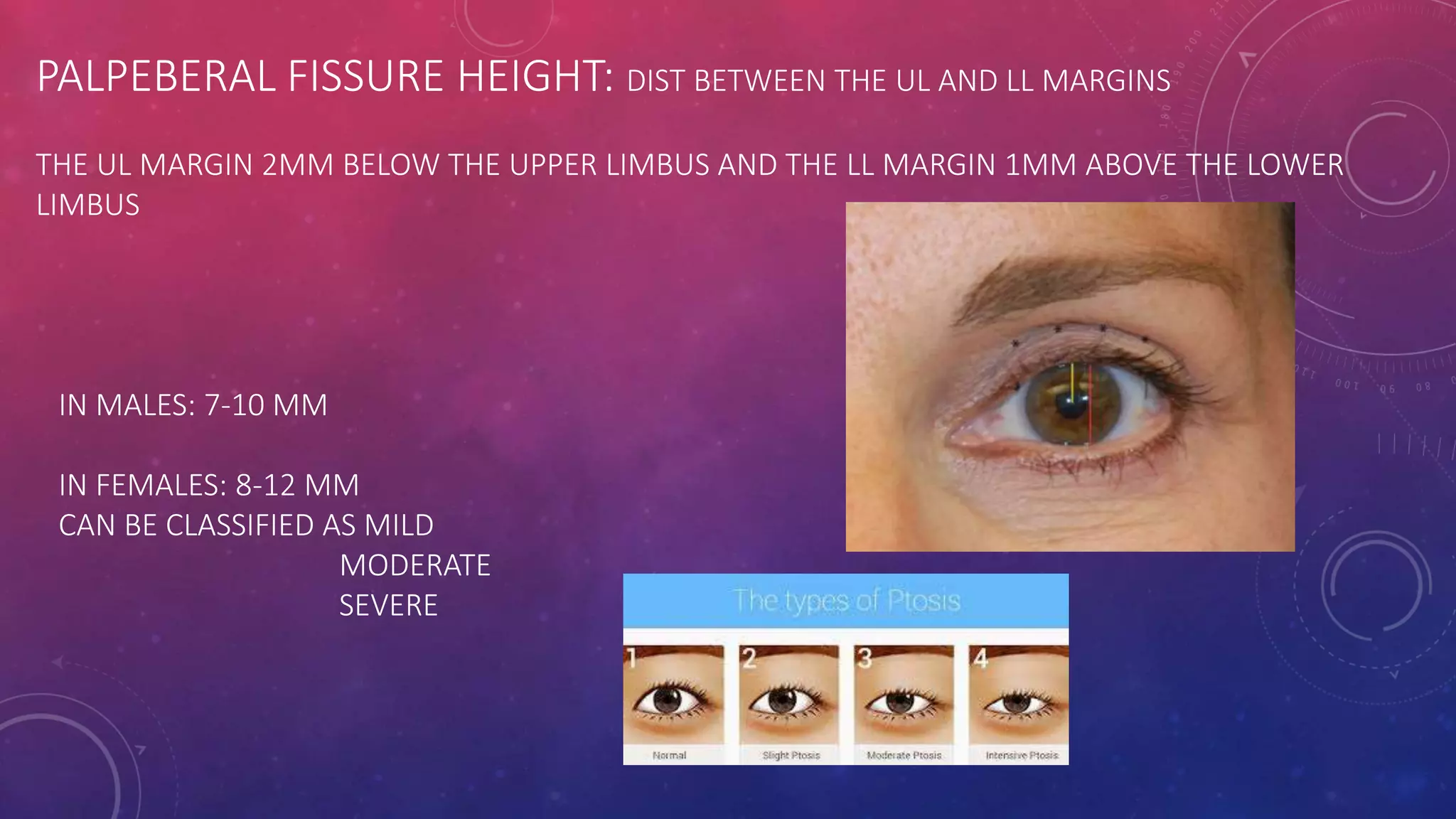 Evaluation of ptosis | PPTX