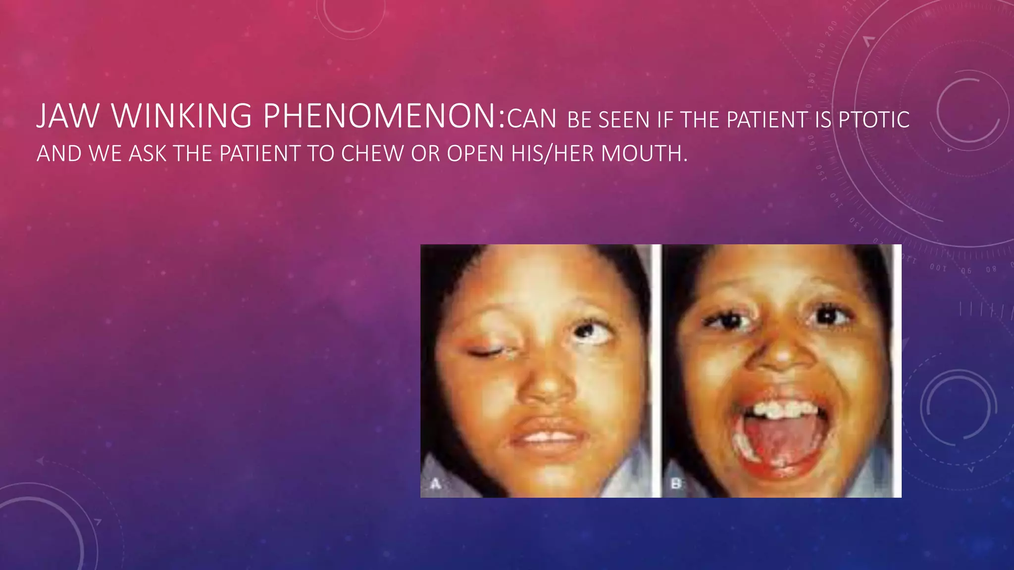 Evaluation of ptosis | PPTX