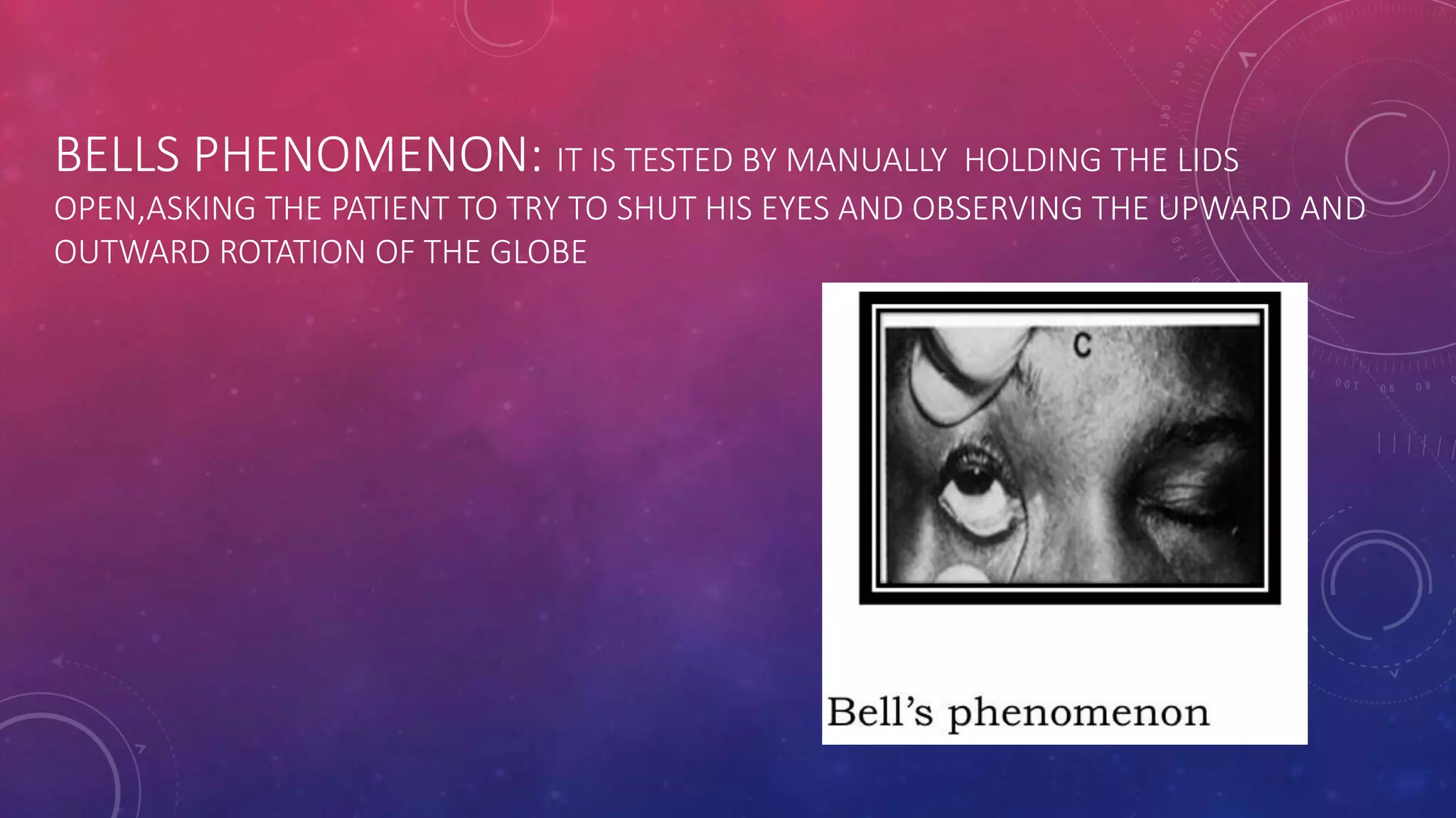 Evaluation of ptosis | PPTX