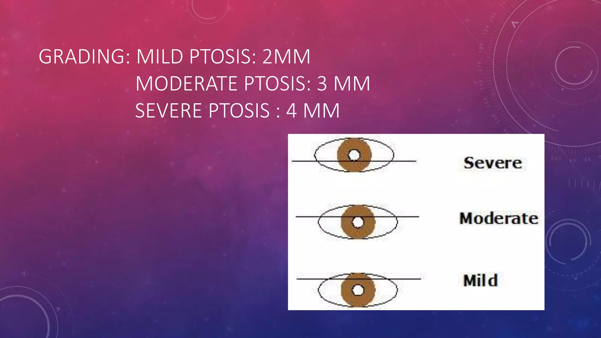 Evaluation of ptosis | PPTX